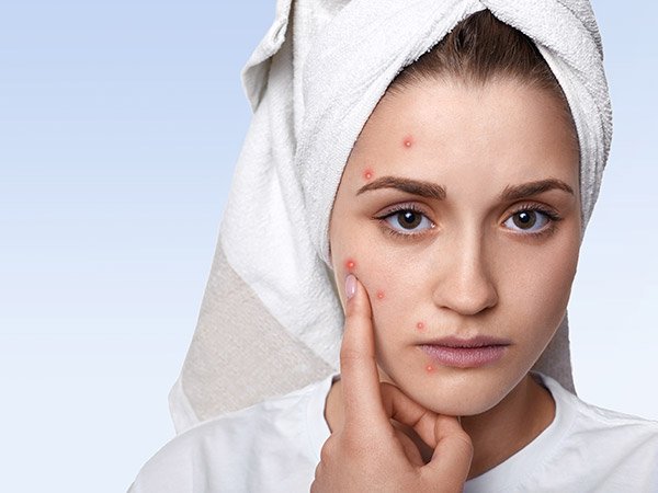 Eiterpickel: Ursachen und Hautpflegetipps | Garnier