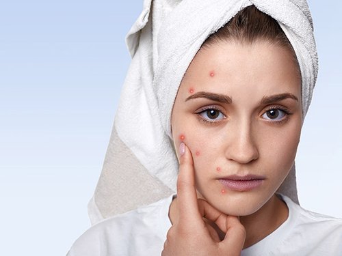 Eiterpickel: Ursachen und Hautpflegetipps | Garnier