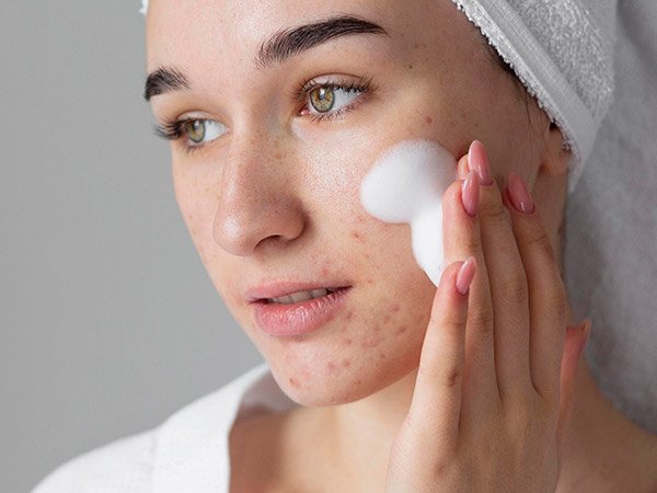 Hormonelle Pickel & Akne behandeln – das steckt dahinter | Garnier