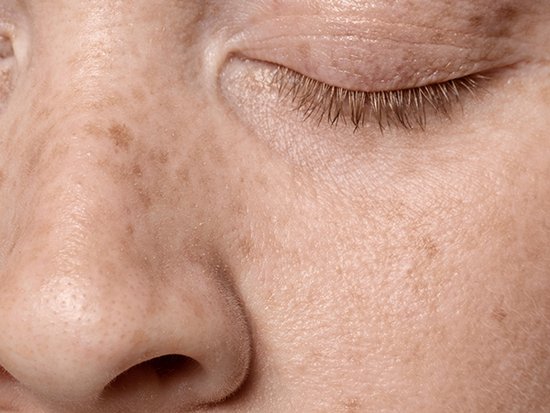 Hyperpigmentierung: Ursachen, Wirkstoffe und Pflegeroutine! | Garnier