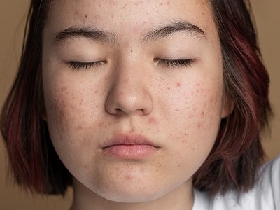 Pickel: Ursachen, Pflegeroutine & Beauty-Tipps | Garnier