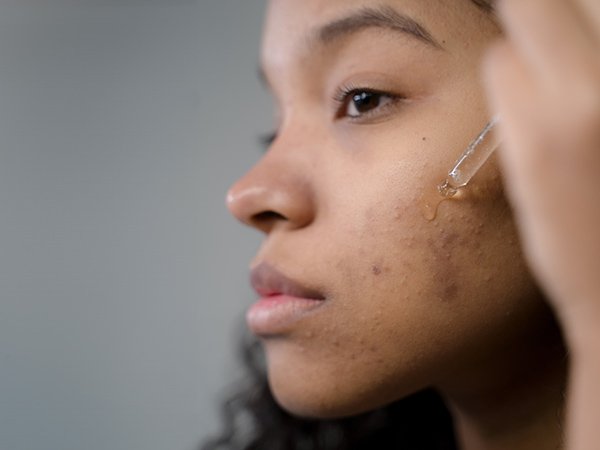 Pigmentflecken entfernen: Unsere Tipps und Tricks | Garnier