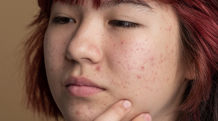 Unterirdischer Pickel: Ursachen, Tipps & Vorbeugung | Garnier