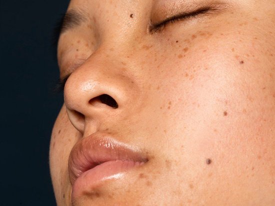 Was hilft gegen Pigmentflecken? Ursachen und Tipps | Garnier